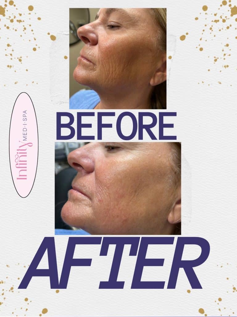 Dermal Fillers in Birmingham, AL | Infinity Med-I-Spa